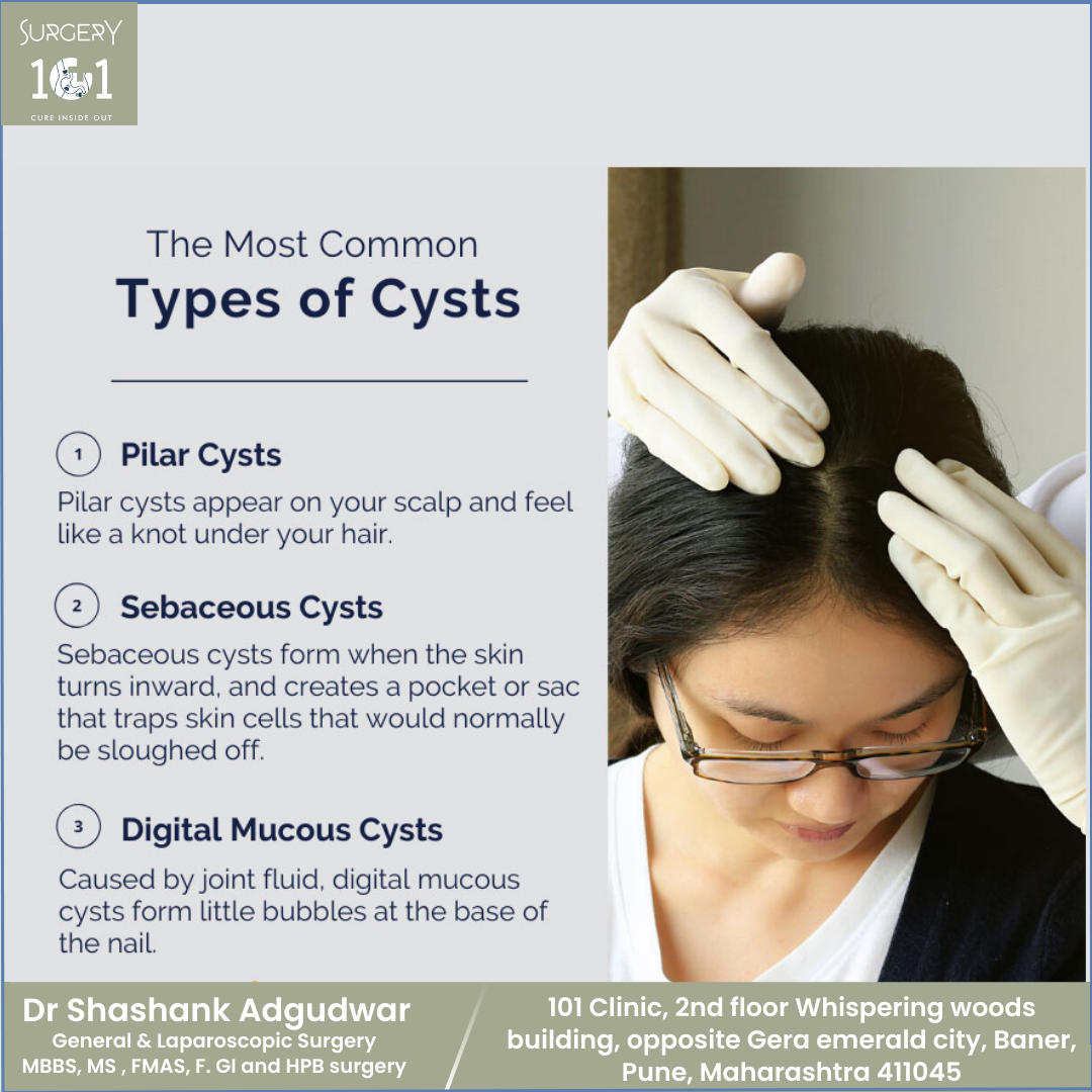 Understanding Common Types of Cysts