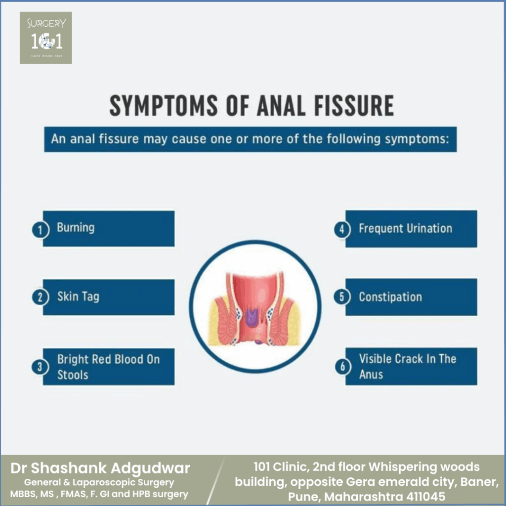 Understanding Anal Fissure – Causes, Symptoms & Treatment