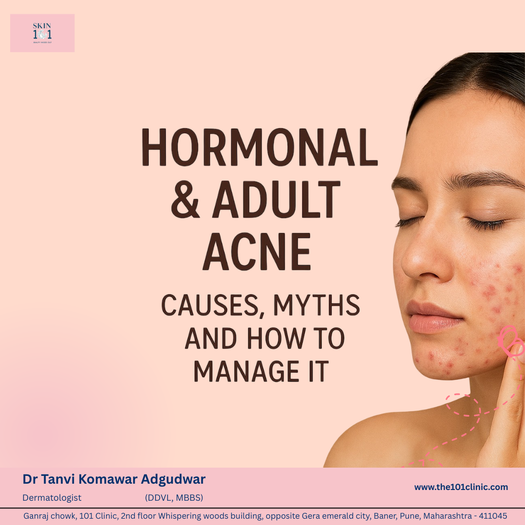 Hormonal & Adult Acne: Causes, Myths and Management | Dr Tanvi Komawar ...